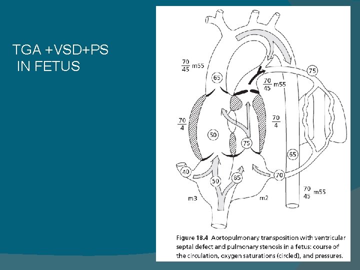 DTGA DR VINOD G V TRANSPOSITION Abnormal origin