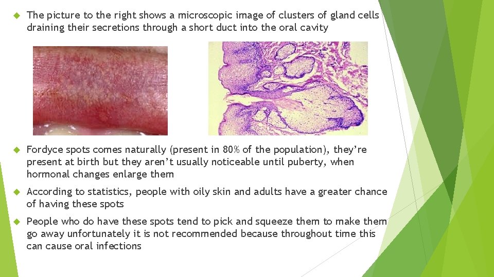 Fordyce Granules Spots Linea Alba Denise Ferreira Section