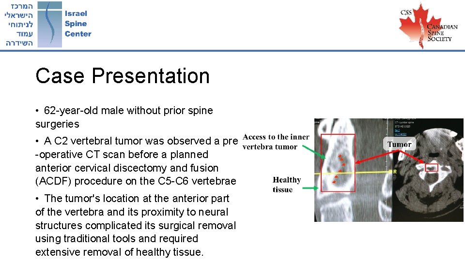 Safe Cervical Tumor Removal Using a Curved Bone