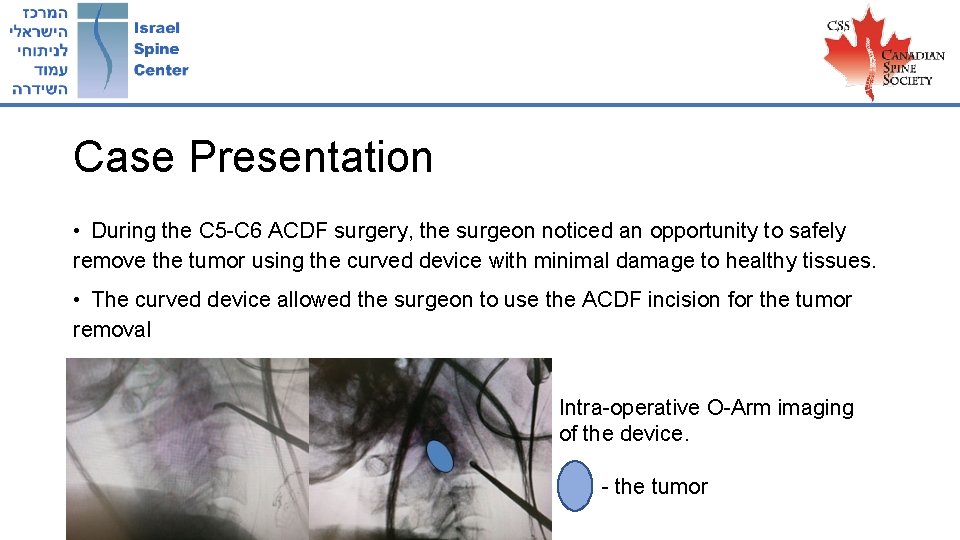 Safe Cervical Tumor Removal Using a Curved Bone