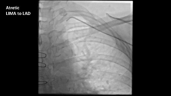 Single PCI for complete revascularization after CABG graft