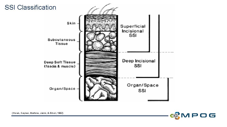 Avoiding Surgical Site Infections Objectives Define surgical site