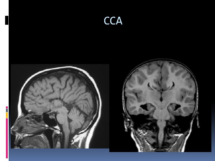 CONGENITAL MALFORMATIONS OF BRAIN AND SKULL PART1 Dr