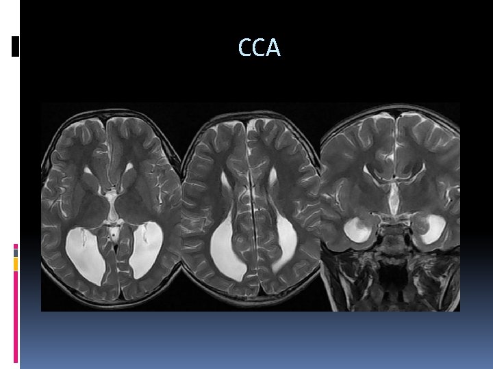CONGENITAL MALFORMATIONS OF BRAIN AND SKULL PART1 Dr