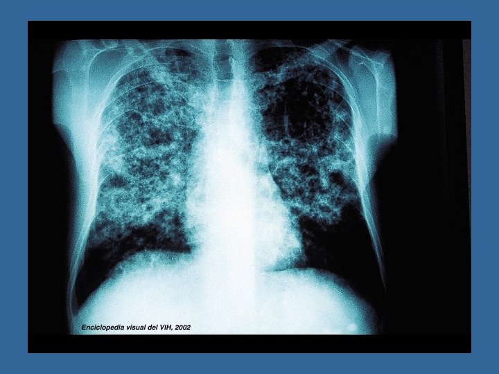 Qu es la Tuberculosis Enfermedad causada por las