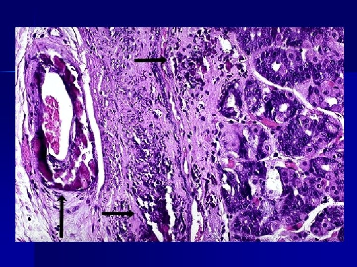 DISPLASIA DISPLASIA n n Es la alteracin citolgica