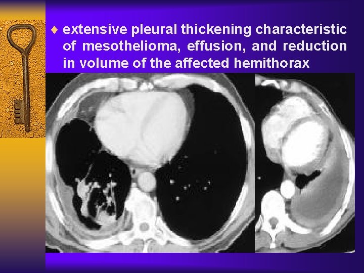 Peritoneal Cancer Stage 4 Male