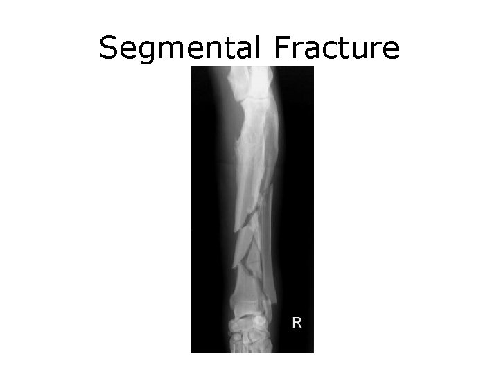 Orthopedics Fractures Orthopedics Orthopedics is that branch of