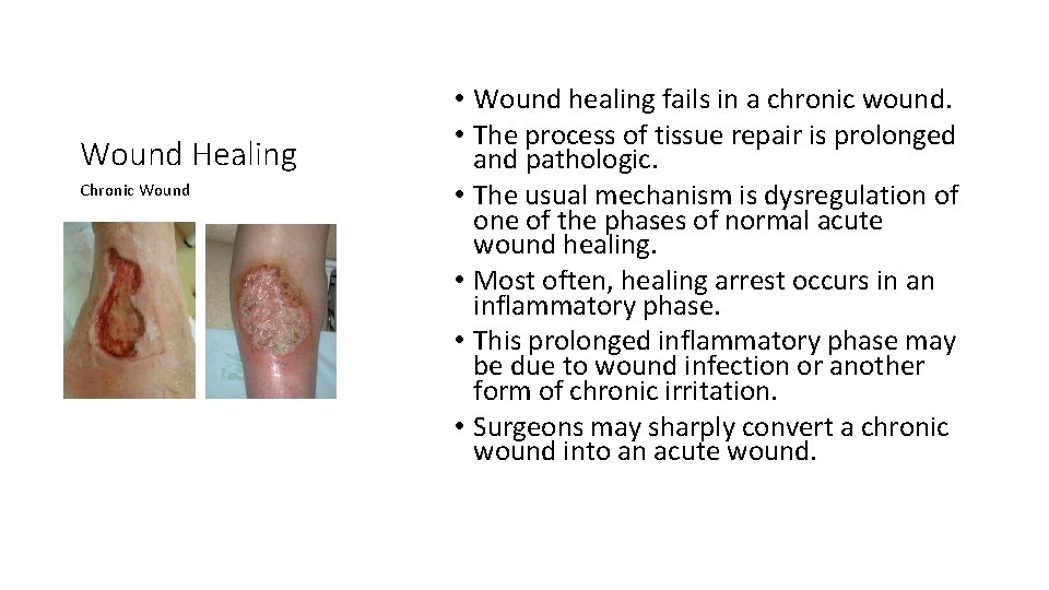 Wound Healing Wound Healing Acute Wound Chronic Wound