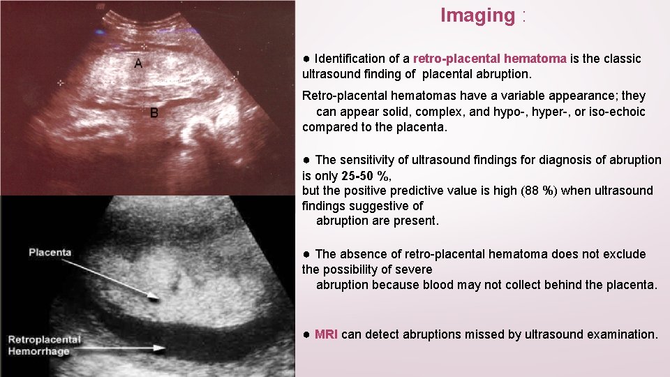 Late pregnancy bleeding Placental Abruption Presented by Aya