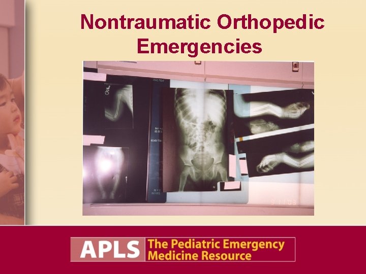 Nontraumatic Orthopedic Emergencies Objectives Understand the ...