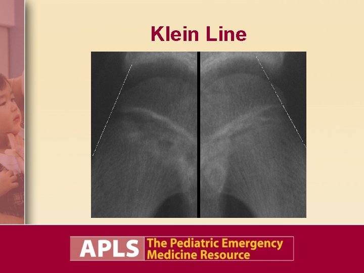 Nontraumatic Orthopedic Emergencies Objectives Understand the ...