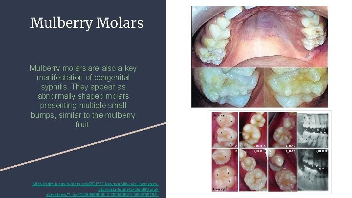 Hutchinson Incisors Mulberry Molars By Luis Marquez P