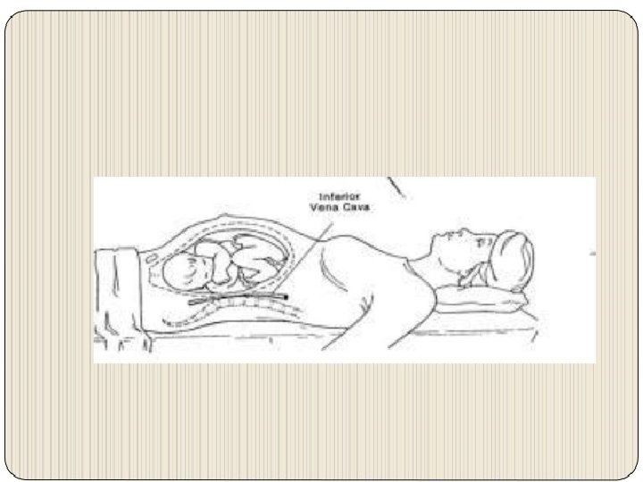 Maternal Cardiopulmonary Resuscitation Basic and Advanced Life Support