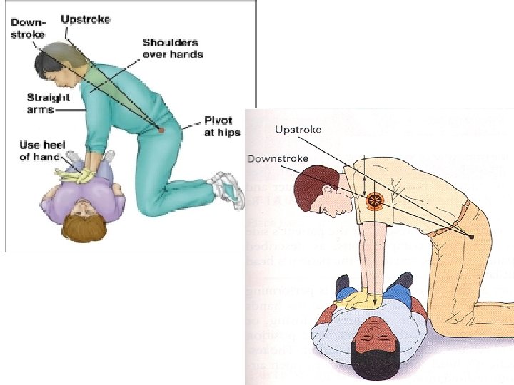 Maternal Cardiopulmonary Resuscitation Basic and Advanced Life Support