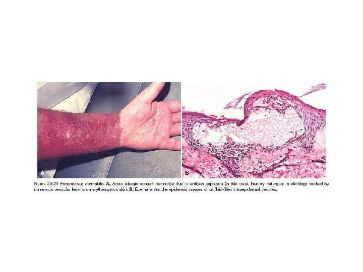 Acute Inflammatory Dermatoses Literally thousands of inflammatory ...