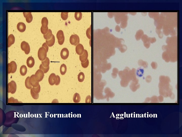 Practical Hematology Lab RBCs Morphology RBCS Abnormal Morphology
