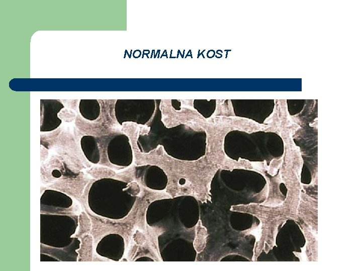 SPREJEM BOLNIKA Z OSTEOPOROTINIM ZLOMOM AVTOR ERNA SRE