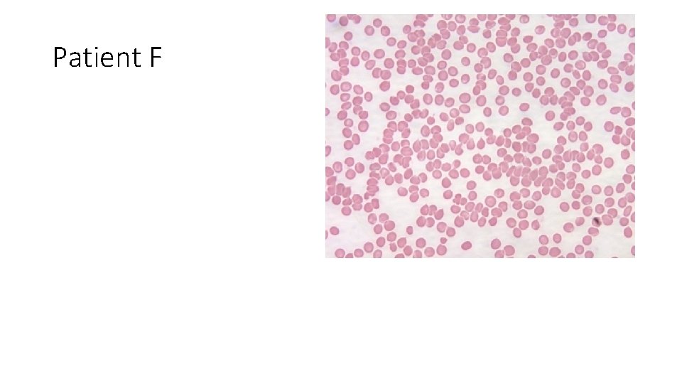 Patient A Patient A Patient Normal Ranges Hb