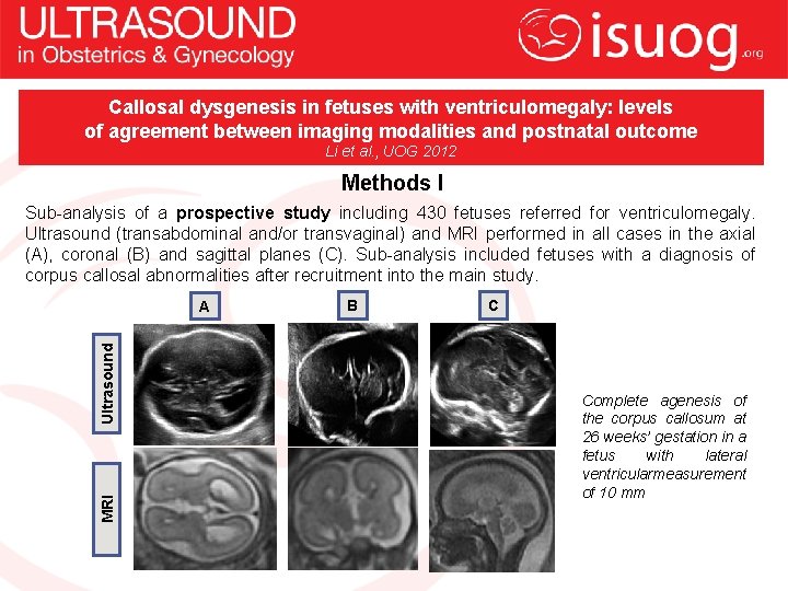 UOG Journal Club November 2012 Callosal dysgenesis in
