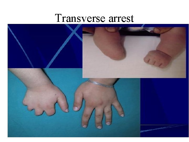 1 Common congenital abnormalities in orthopaedics DR ANIPOLE