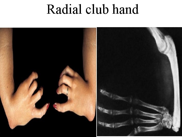 1 Common congenital abnormalities in orthopaedics DR ANIPOLE