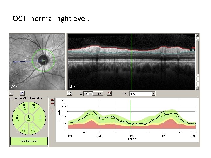 Use of new oral anticoagulants in retinal trombosis
