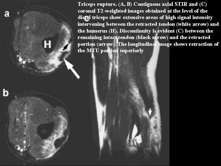 Magnetic Resonance Imaging of Muscles Magnetic resonance MR