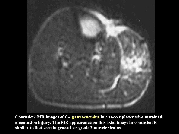 Magnetic Resonance Imaging of Muscles Magnetic resonance MR