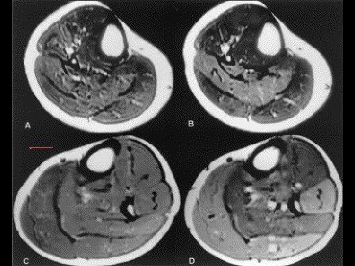 Magnetic Resonance Imaging of Muscles Magnetic resonance MR