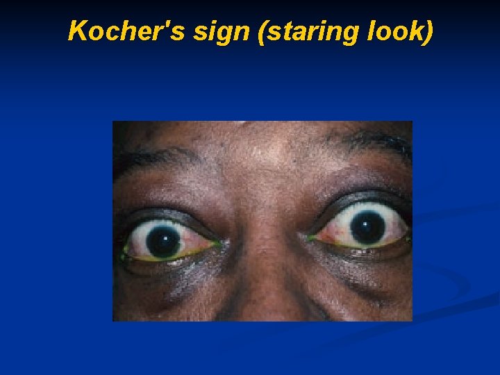 Types n Dysthyroid ophthalmopathy orbitopathy n Orbital inflammatory