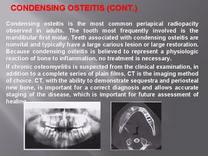 INTERPRETATION OF PULPAL AND PERIAPICAL LESIONS Radiographic Changes