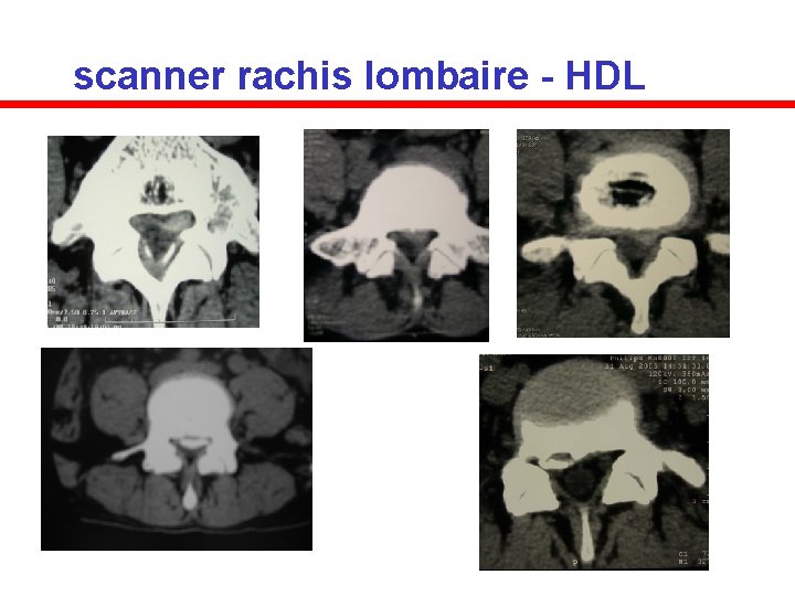Chirurgie arthrose rachidienne Guillaume LOT Service de Neurochirurgie