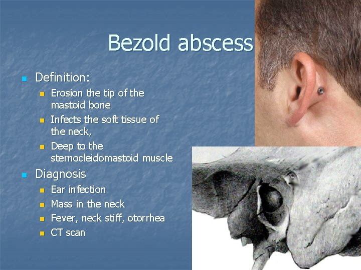 Complications of Chronic Otitis Media Chunfu Dai Three