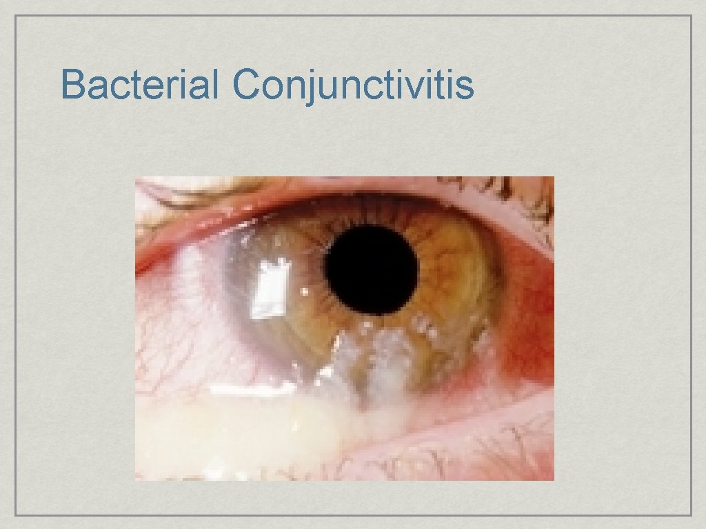 Trichiasis Conjunctiva Sclera Look at the bulbar the