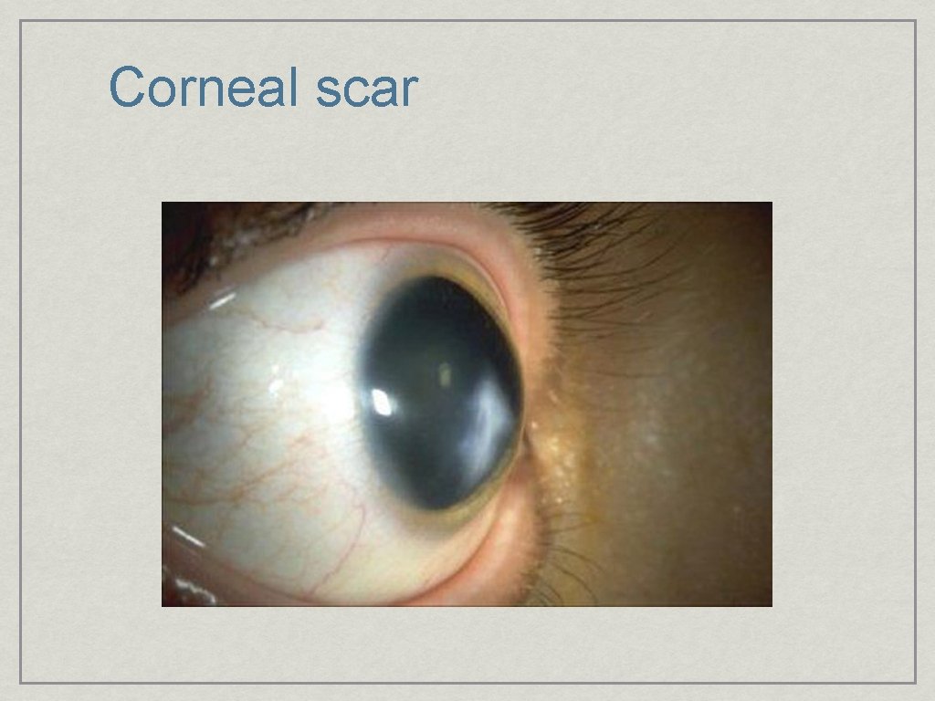 Trichiasis Conjunctiva Sclera Look at the bulbar the