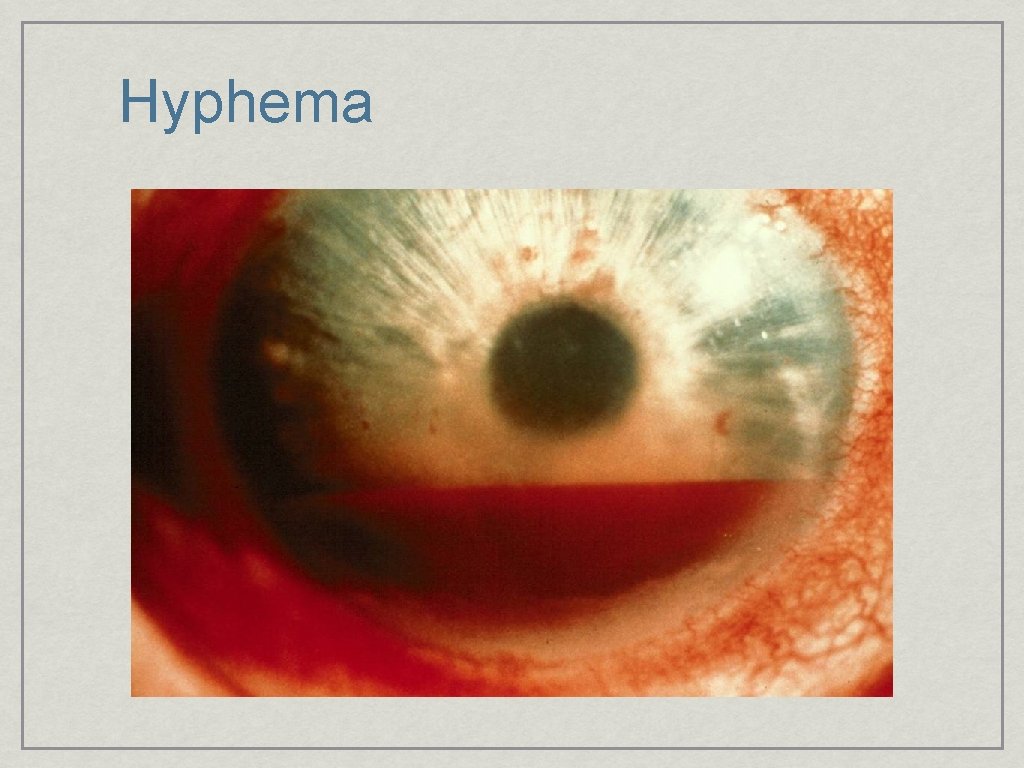 Trichiasis Conjunctiva Sclera Look at the bulbar the