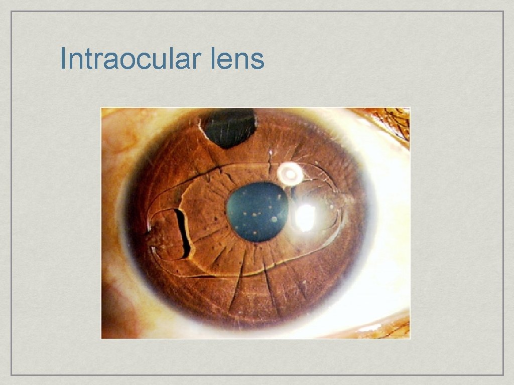 Trichiasis Conjunctiva Sclera Look at the bulbar the