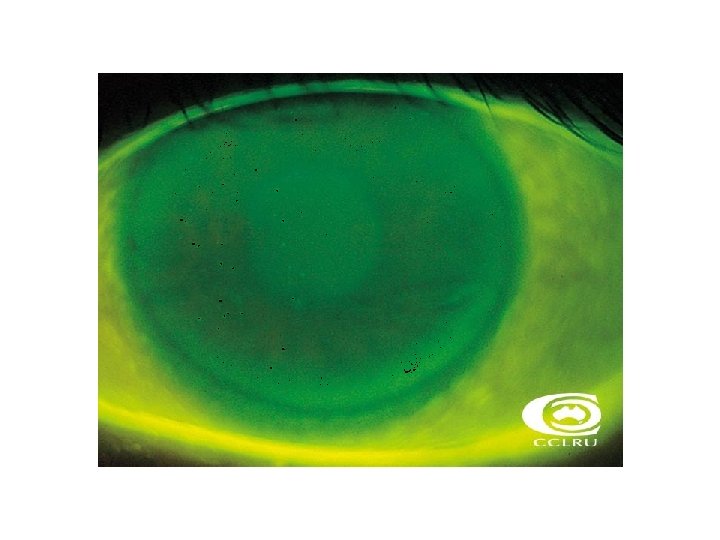 Corneal Staining CCLRU Image Analysis We fixed the
