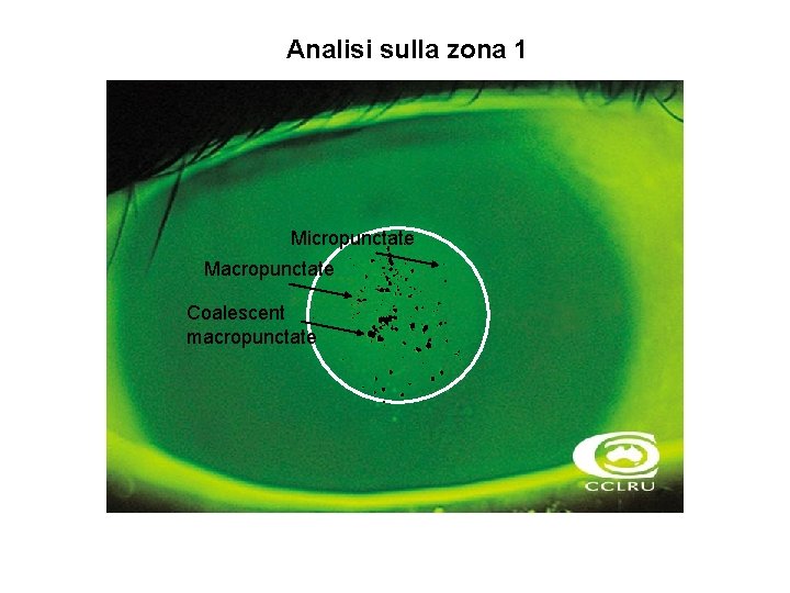Corneal Staining CCLRU Image Analysis We fixed the