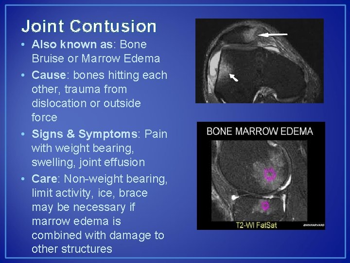 Chapter 16 The Knee Related Structures Bones Patella