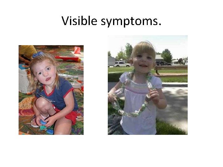 CHARGE Syndrome By Kylie Le Hew Whitney Webb