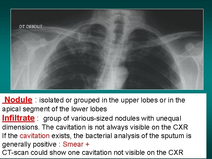 Pulmonary TB aspects Nodule infiltrate Cavern Pneumonia Etienne