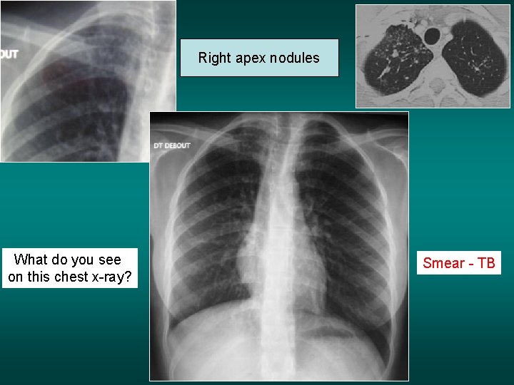 Pulmonary TB aspects Nodule infiltrate Cavern Pneumonia Etienne