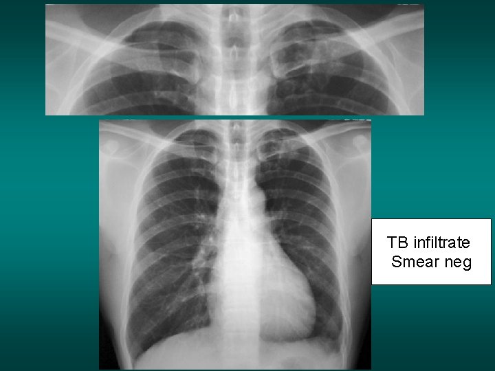 Pulmonary TB aspects Nodule infiltrate Cavern Pneumonia Etienne