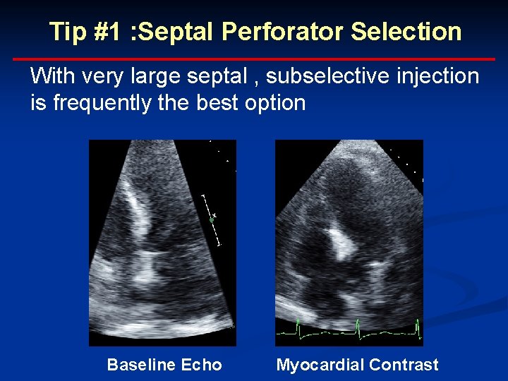 Alcohol Septal Ablation Tips for Success Tuesday February