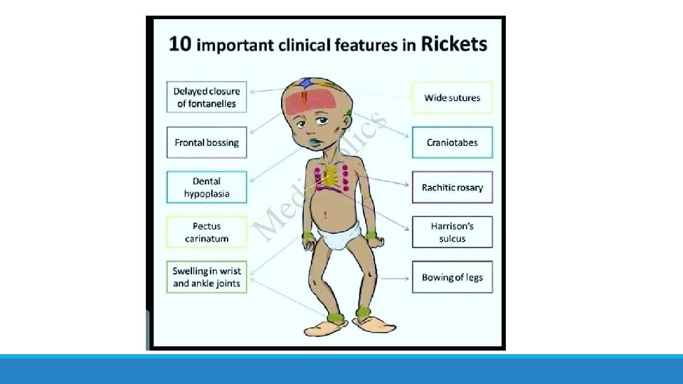 Rickets What are Rickets Disease of growing bones