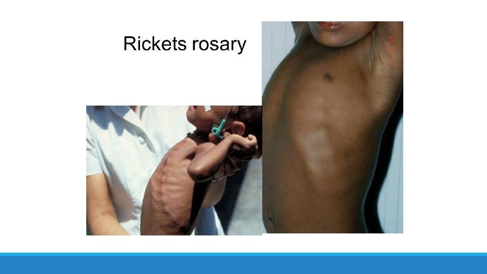 Rickets What are Rickets Disease of growing bones