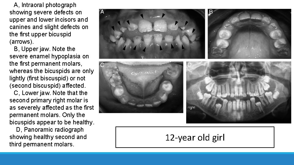 Rickets What are Rickets Disease of growing bones