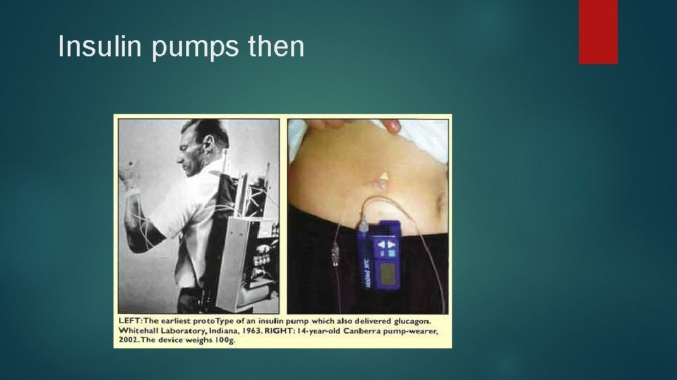 What is new in management of pediatric diabetes